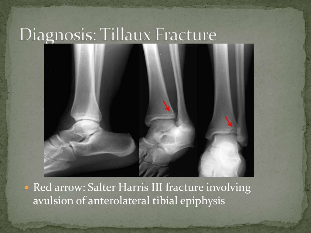 Tillaux Fracture
