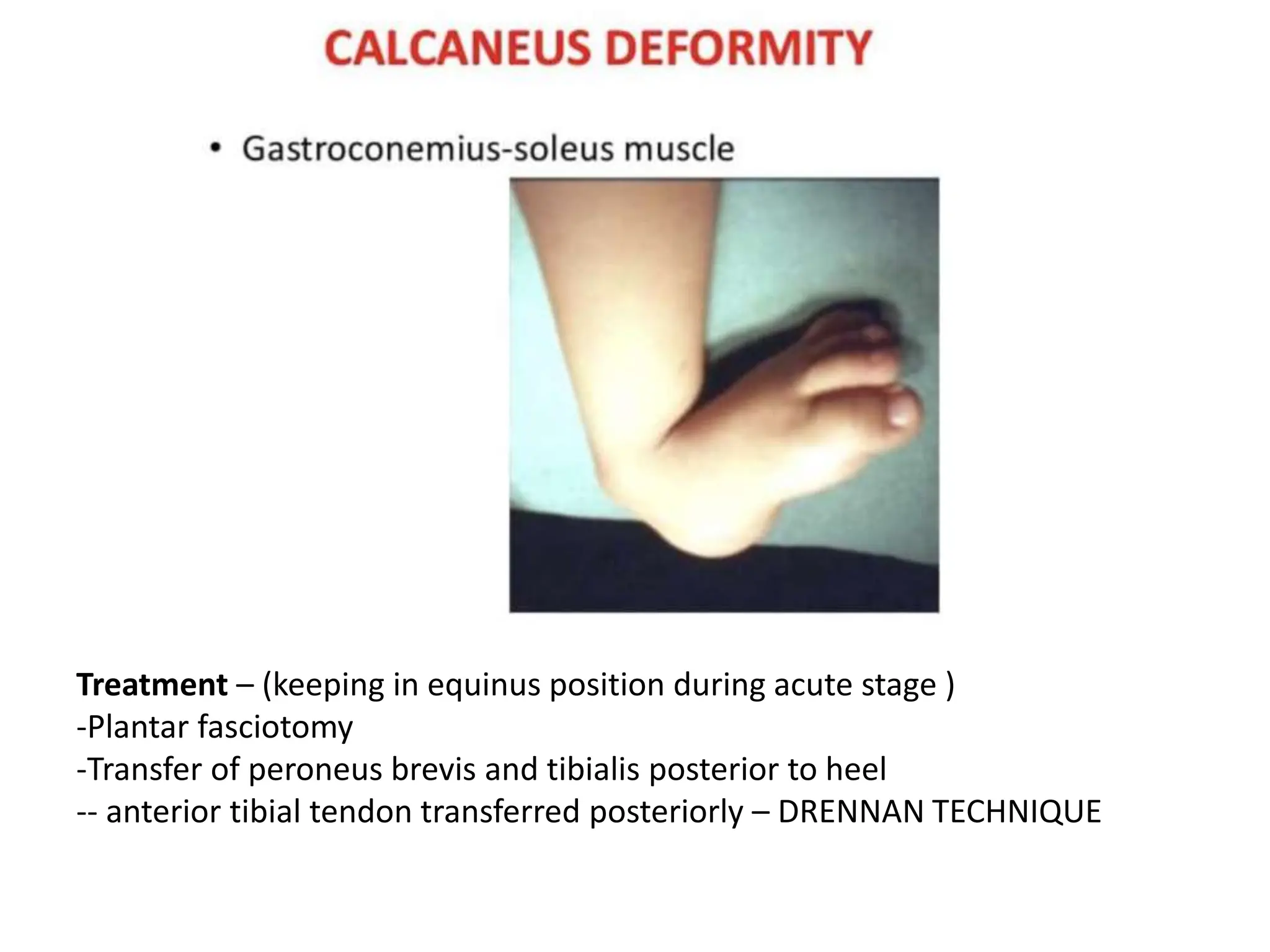 ANKLE AND FOOT DEFORMITIES IN polio.pptx