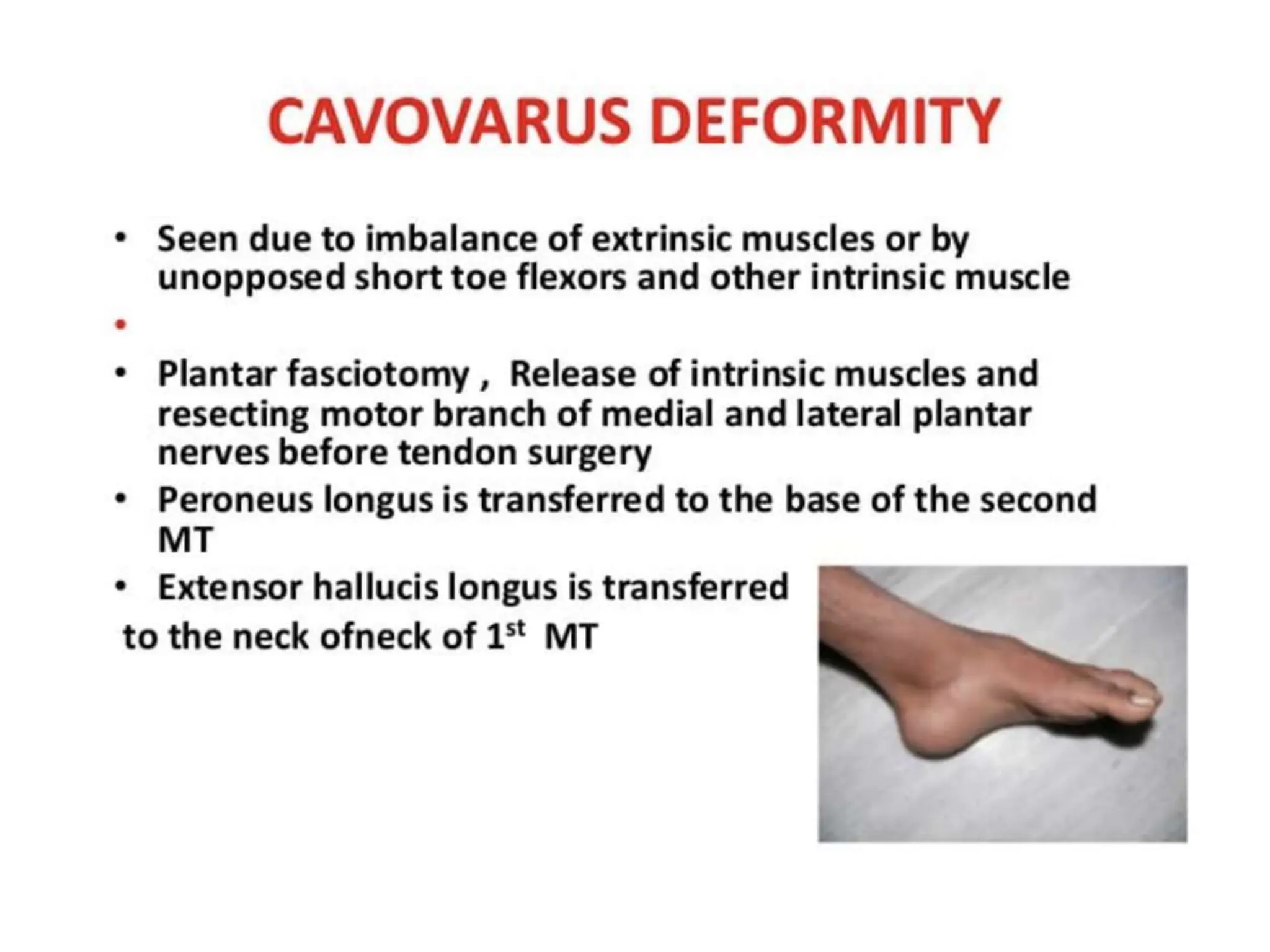 ANKLE AND FOOT DEFORMITIES IN polio.pptx