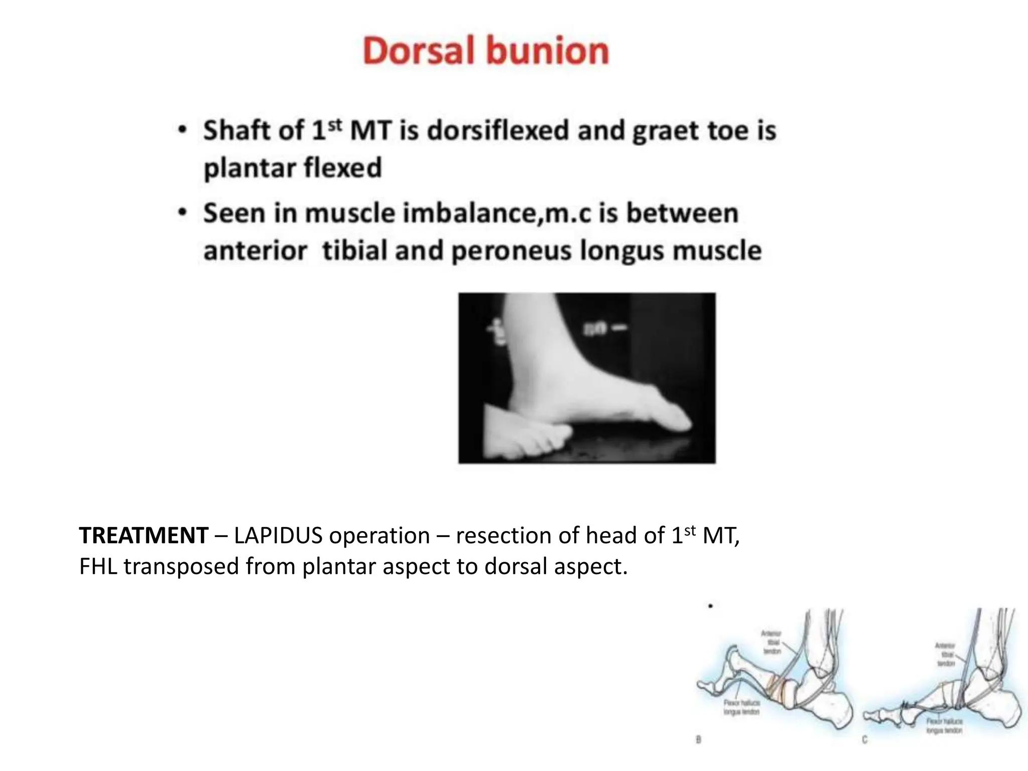 ANKLE AND FOOT DEFORMITIES IN polio.pptx
