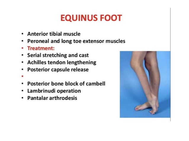 ANKLE AND FOOT DEFORMITIES IN polio.pptx