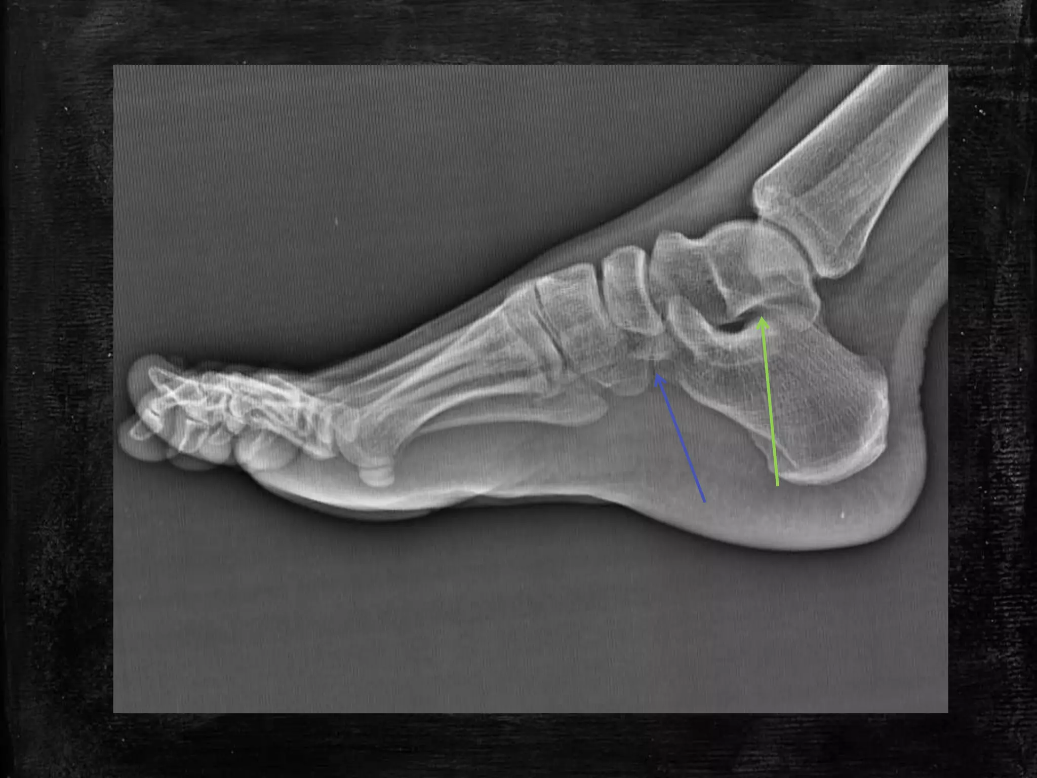 Normal Ankle and foot Radiographs by Dr Avinash | PPTX