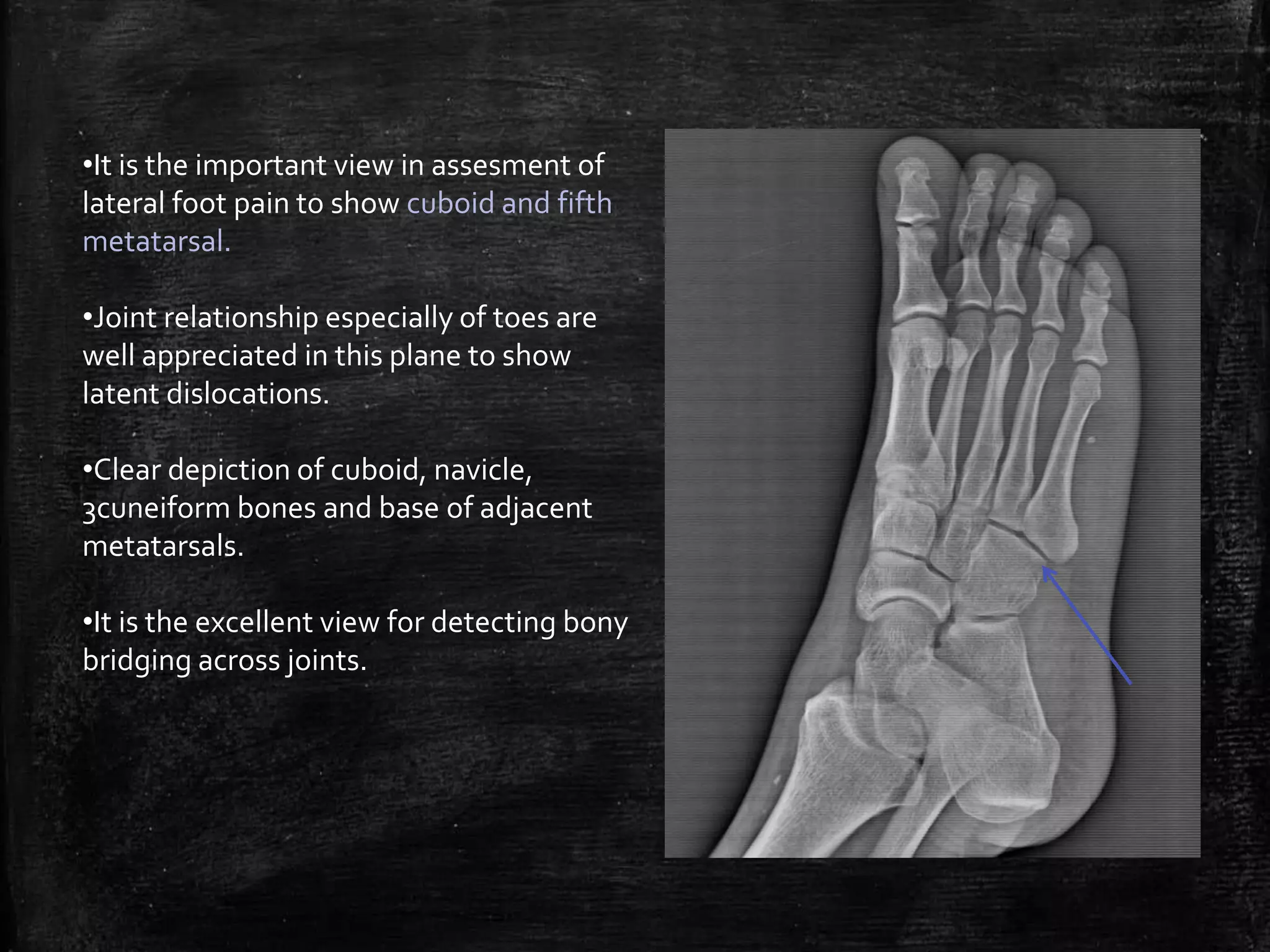 Normal Ankle and foot Radiographs by Dr Avinash | PPTX