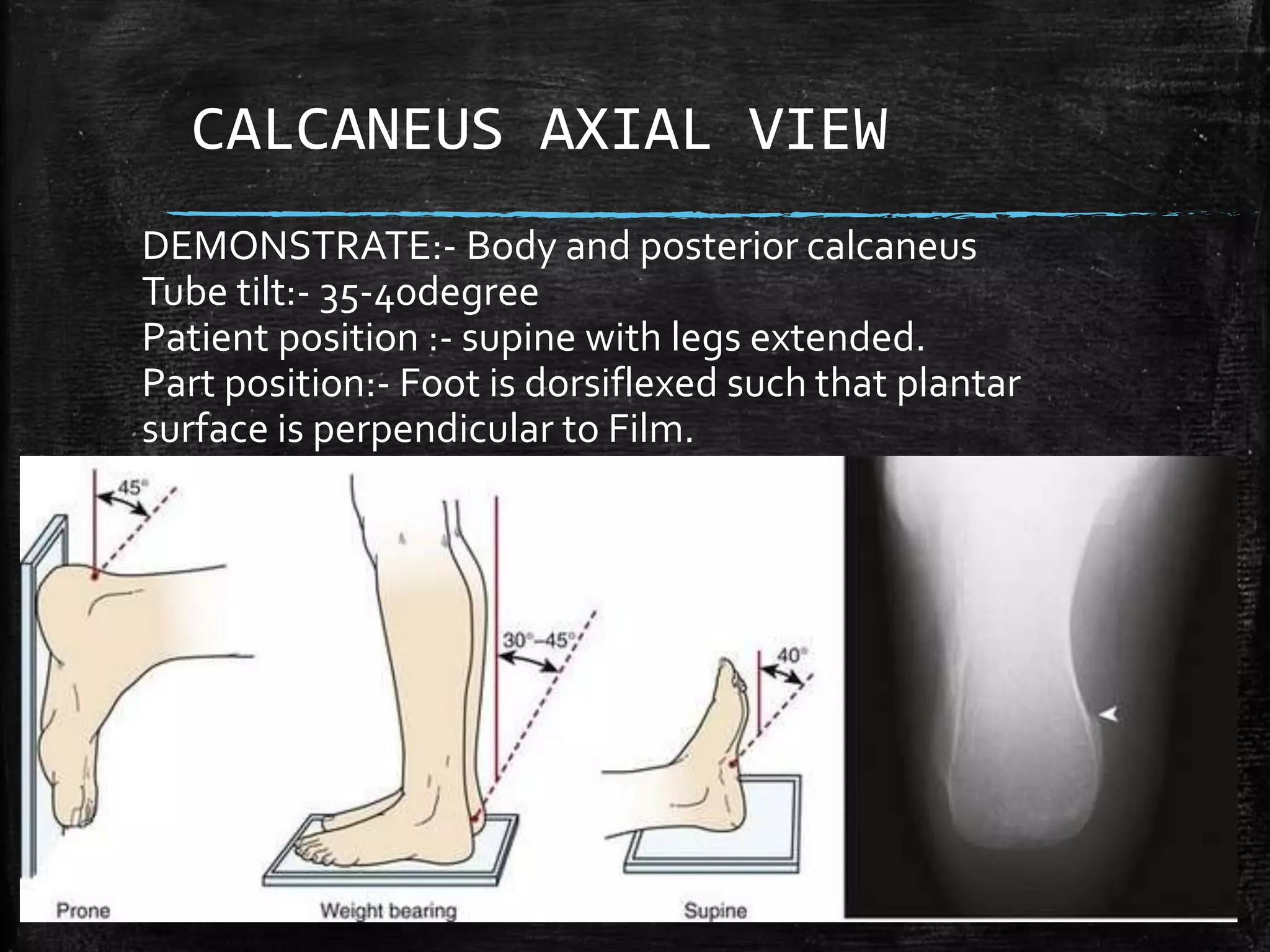 Normal Ankle and foot Radiographs by Dr Avinash | PPTX