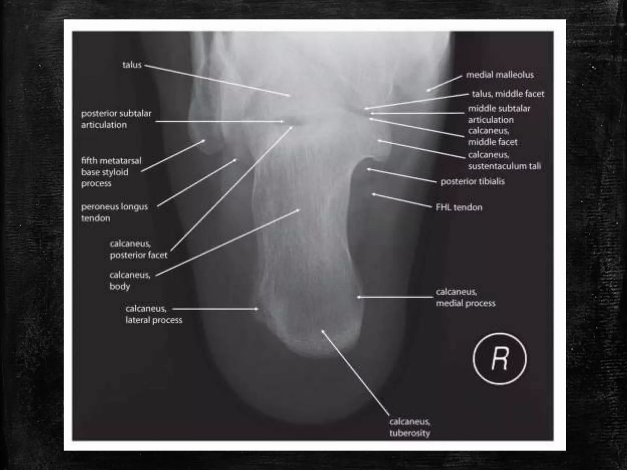 Normal Ankle and foot Radiographs by Dr Avinash | PPTX