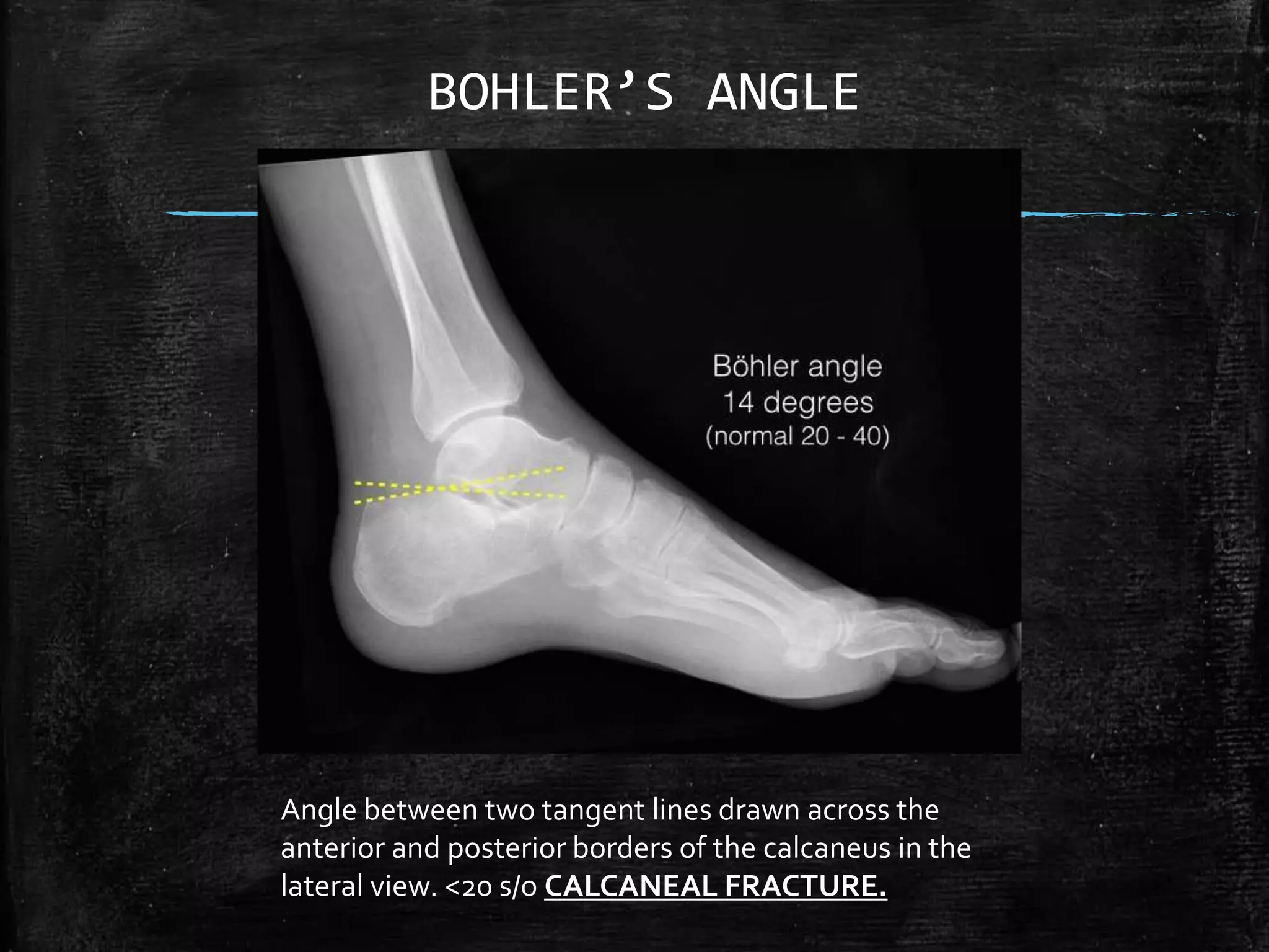 Normal Ankle and foot Radiographs by Dr Avinash | PPTX
