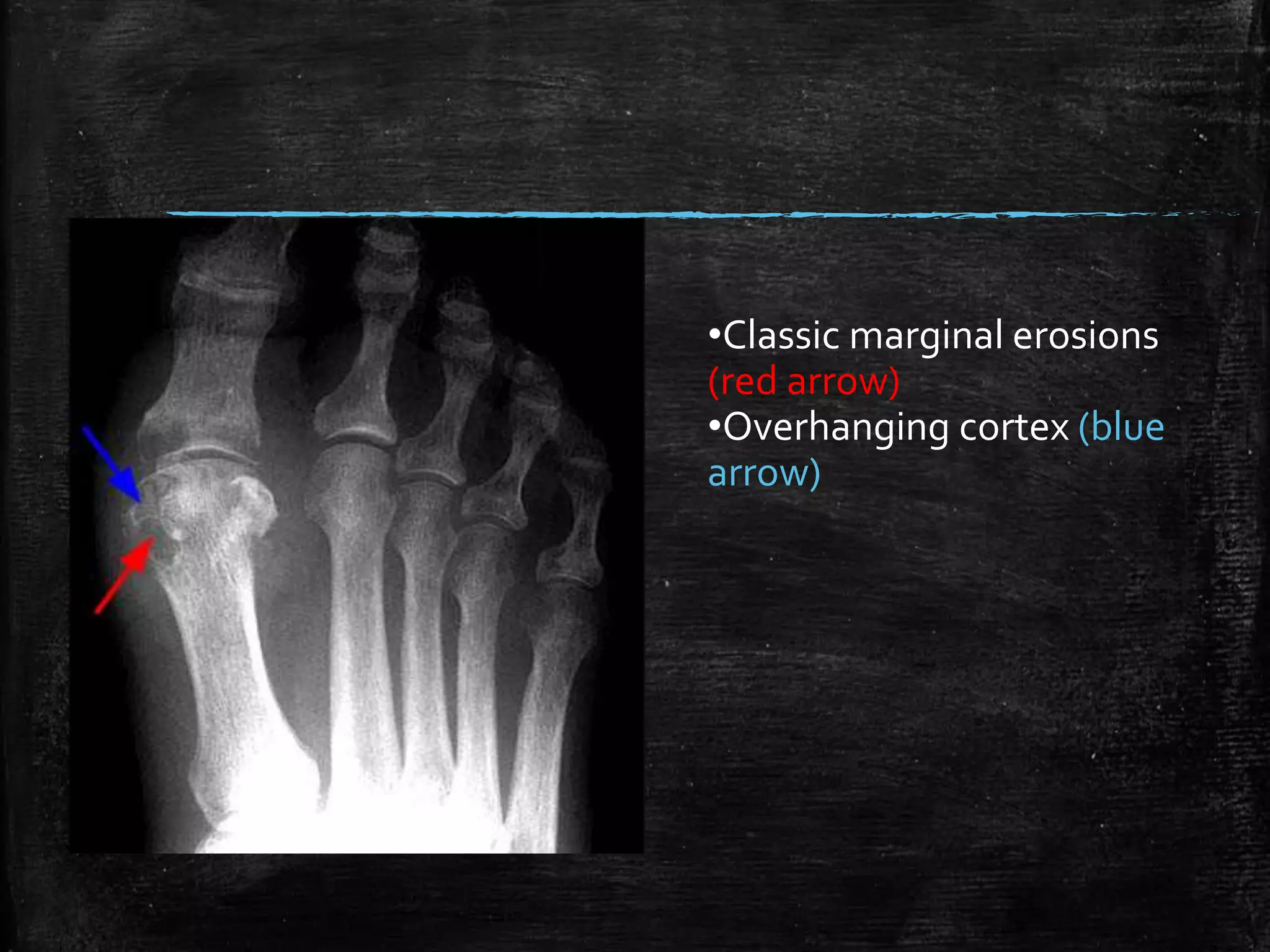 Normal Ankle and foot Radiographs by Dr Avinash | PPTX