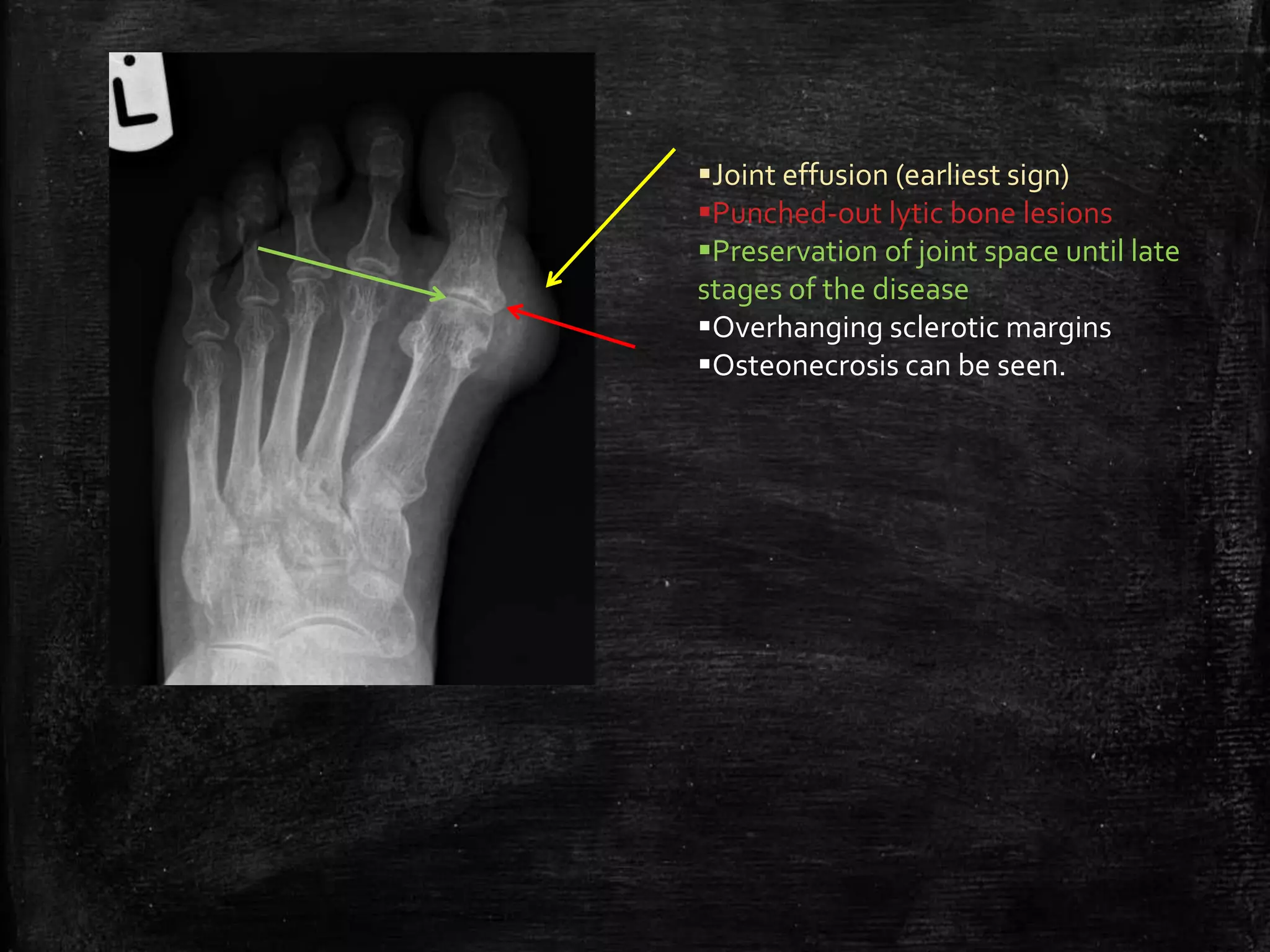 Normal Ankle and foot Radiographs by Dr Avinash | PPTX