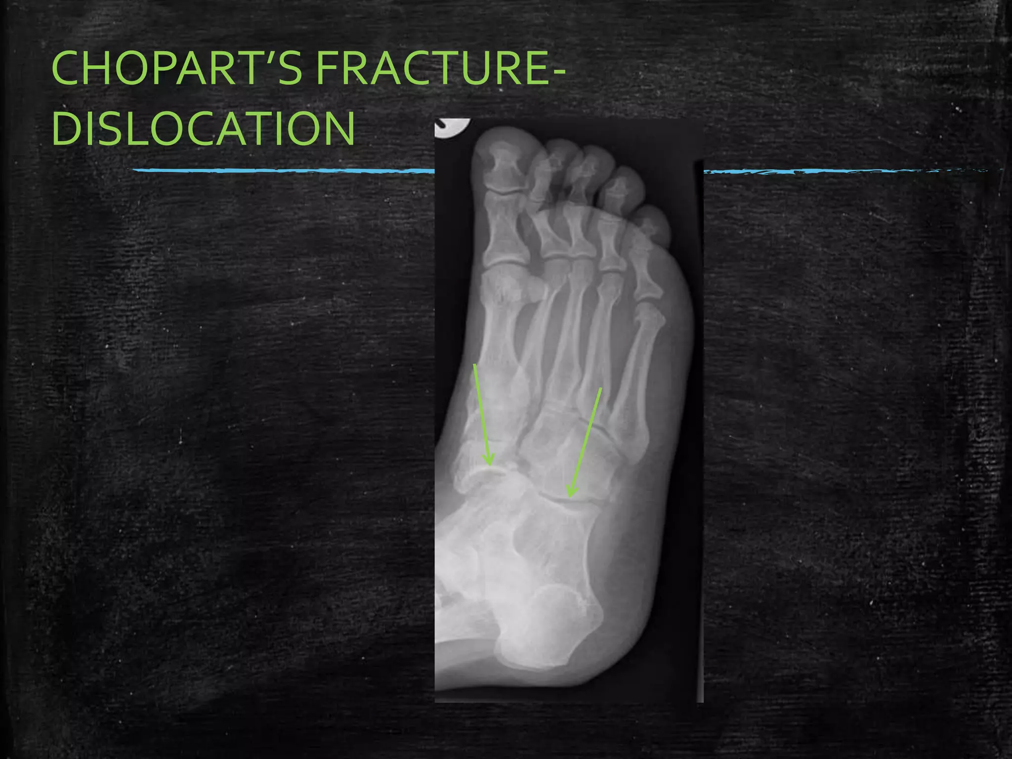 Normal Ankle and foot Radiographs by Dr Avinash | PPTX