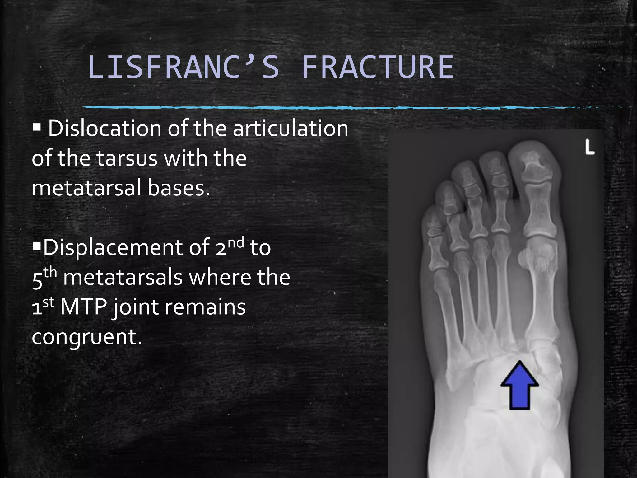 Normal Ankle and foot Radiographs by Dr Avinash | PPTX