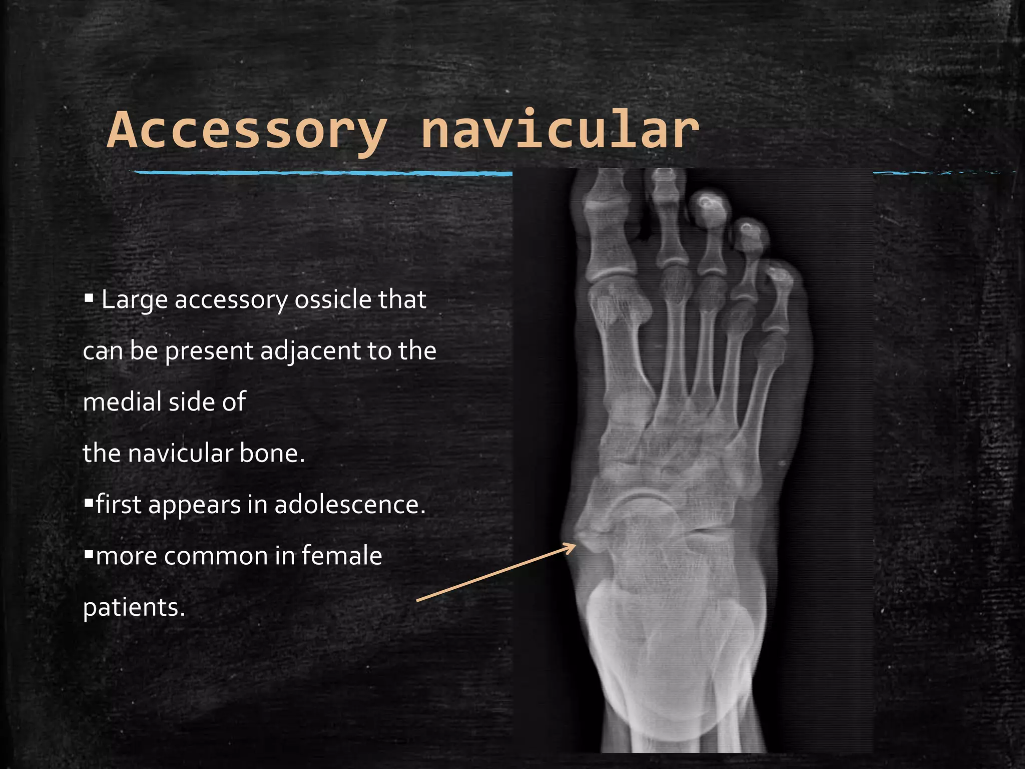Normal Ankle and foot Radiographs by Dr Avinash | PPTX
