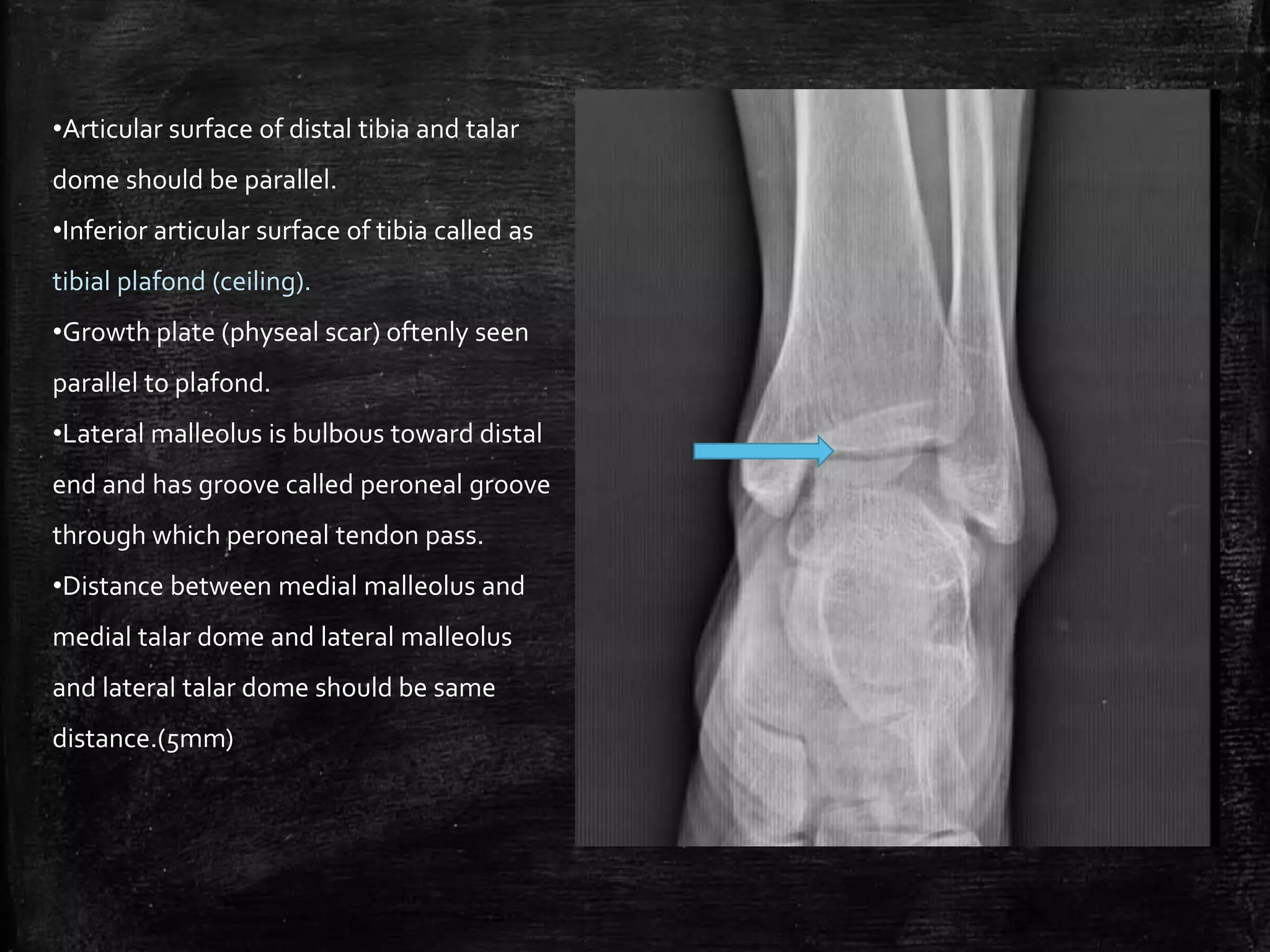 Normal Ankle and foot Radiographs by Dr Avinash | PPTX