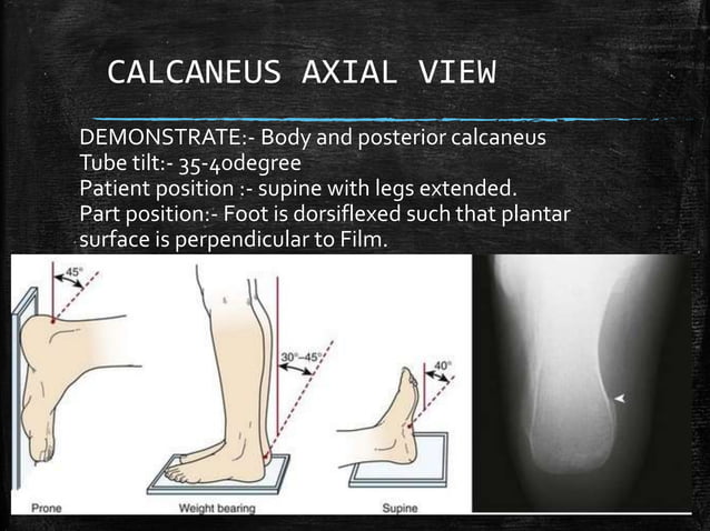 Normal Ankle and foot Radiographs by Dr Avinash | PPTX | Death, Injury ...