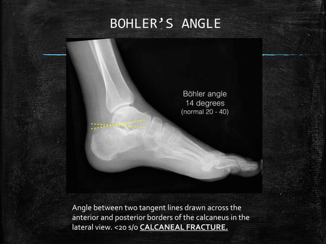 Normal Ankle and foot Radiographs by Dr Avinash | PPTX | Death, Injury ...