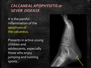 Normal Ankle and foot Radiographs by Dr Avinash | PPTX