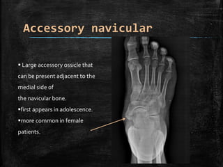 Normal Ankle and foot Radiographs by Dr Avinash | PPTX