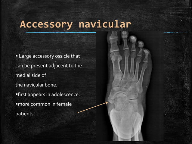 Normal Ankle and foot Radiographs by Dr Avinash | PPTX | Death, Injury ...