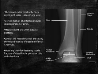 Normal Ankle and foot Radiographs by Dr Avinash | PPTX