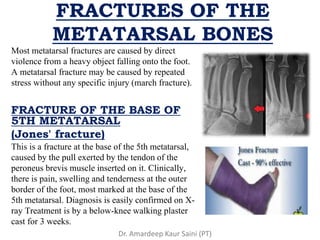 Ankle and foot injuries | PPTX