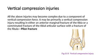 ANKLE AND FOOT INJURIES // Treatment .pptx