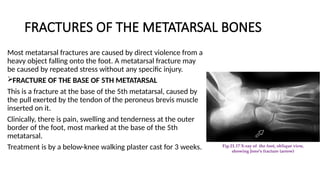 ANKLE AND FOOT INJURIES // Treatment .pptx