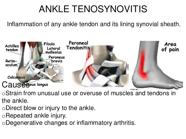 Ankle and foot pain