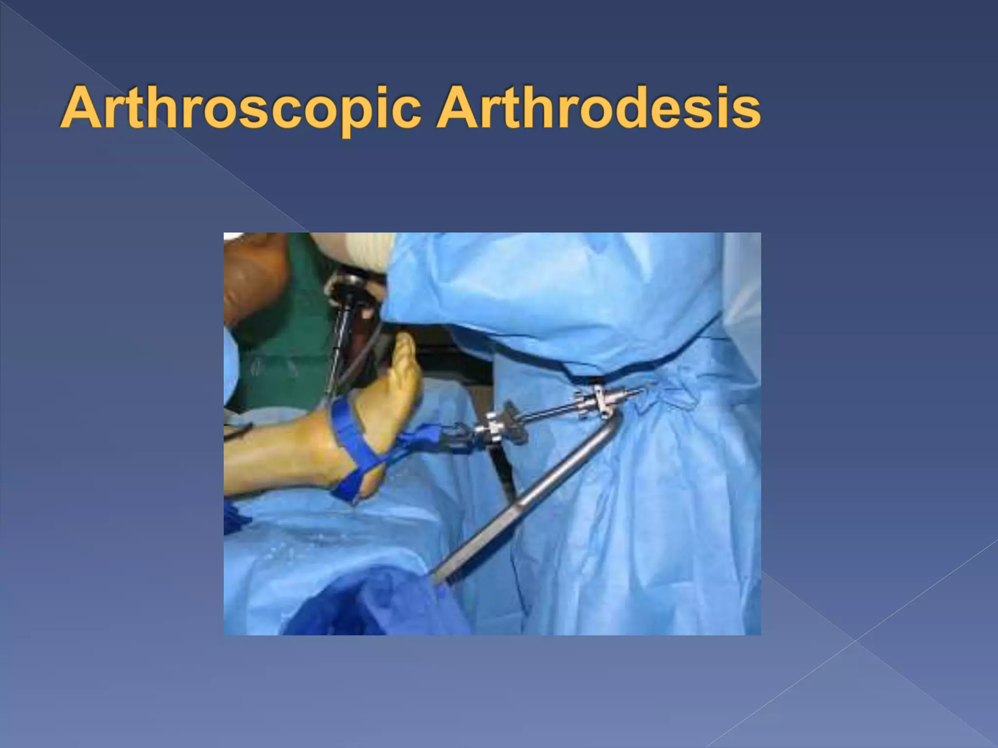 Ankle Arthodesis.pptx