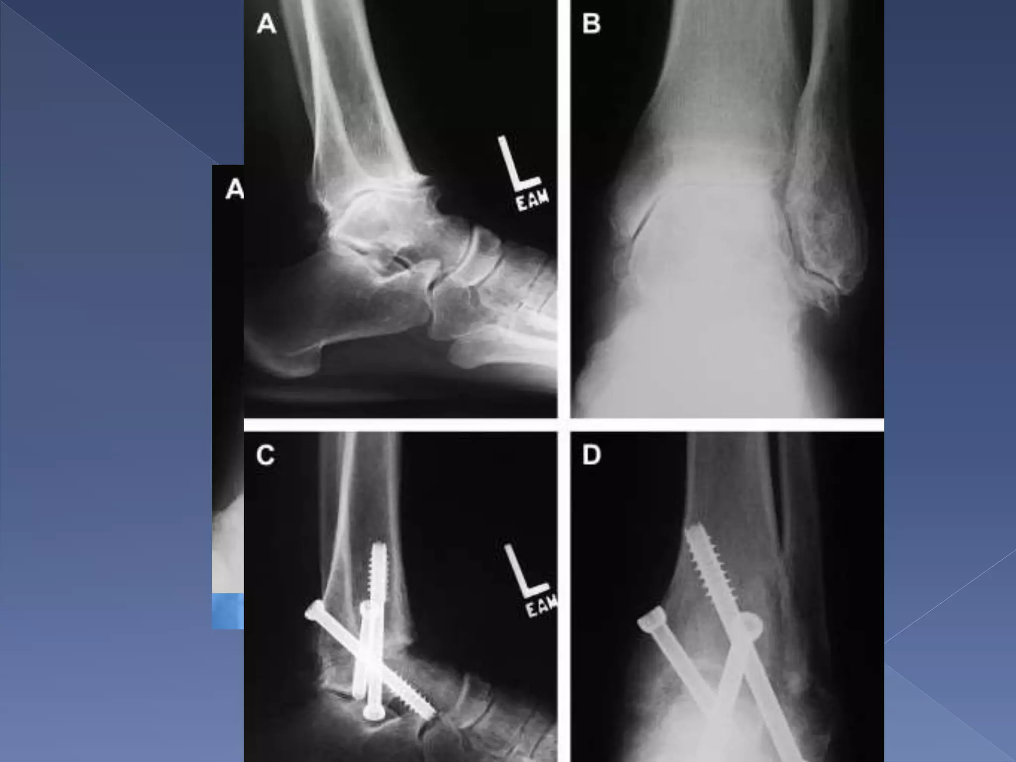 Ankle Arthodesis.pptx