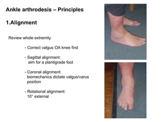 Ankle arthritis - Derek Park | PPT