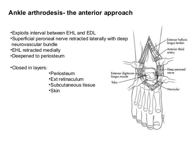 Ankle arthritis - Derek Park