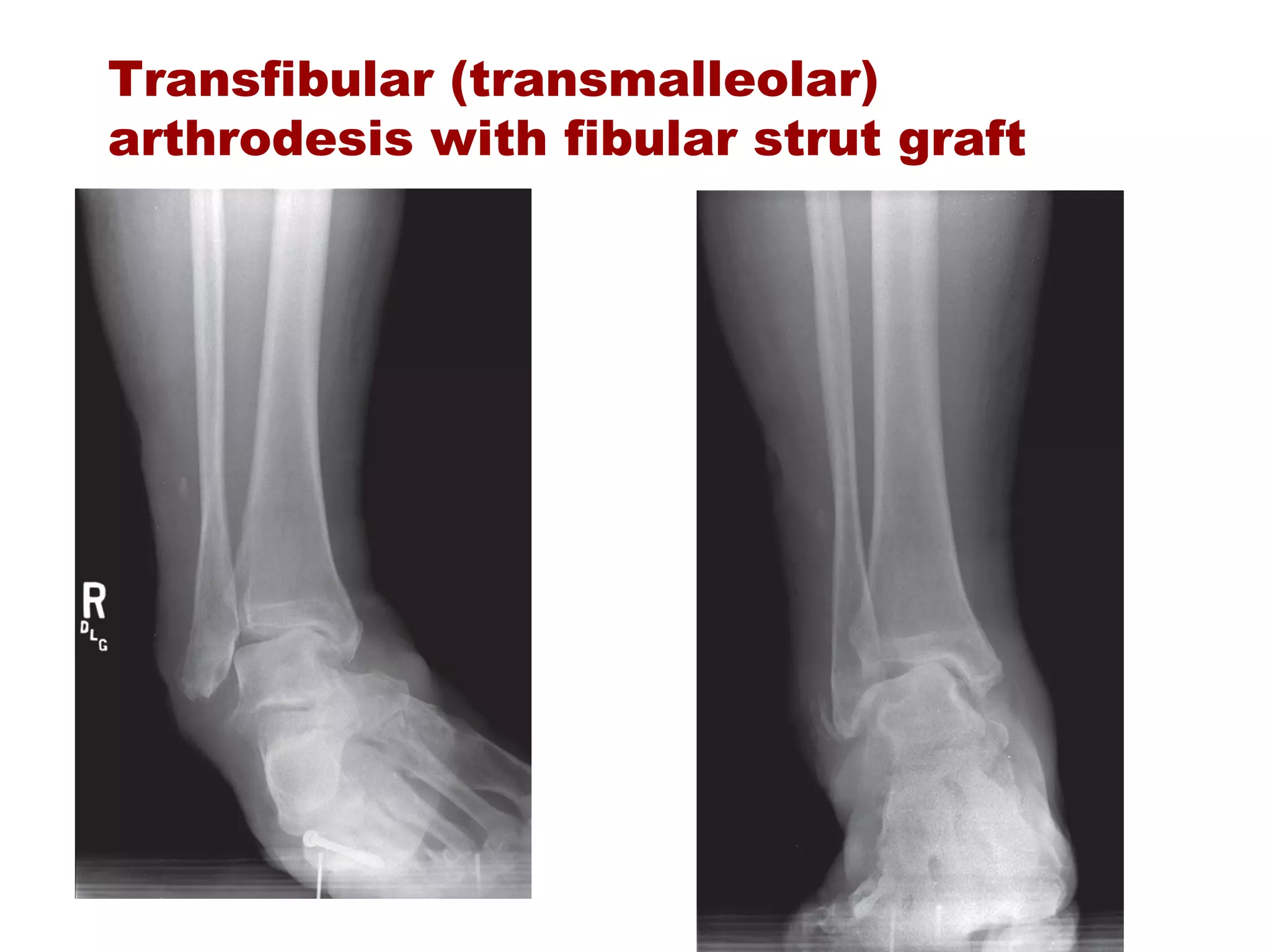Ankle and foot arthrodesis | PPT