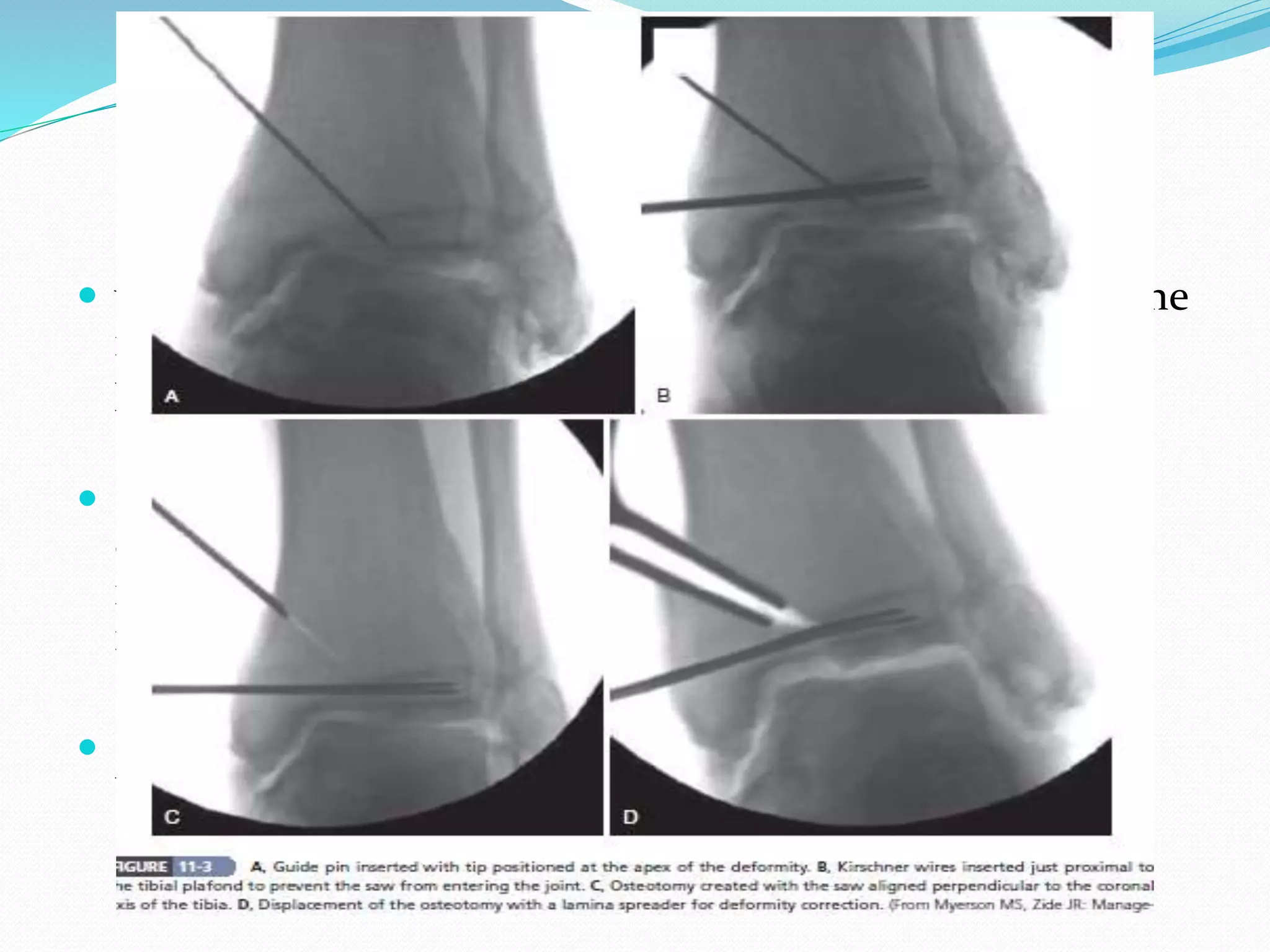 Ankle arthrodesis | PPTX