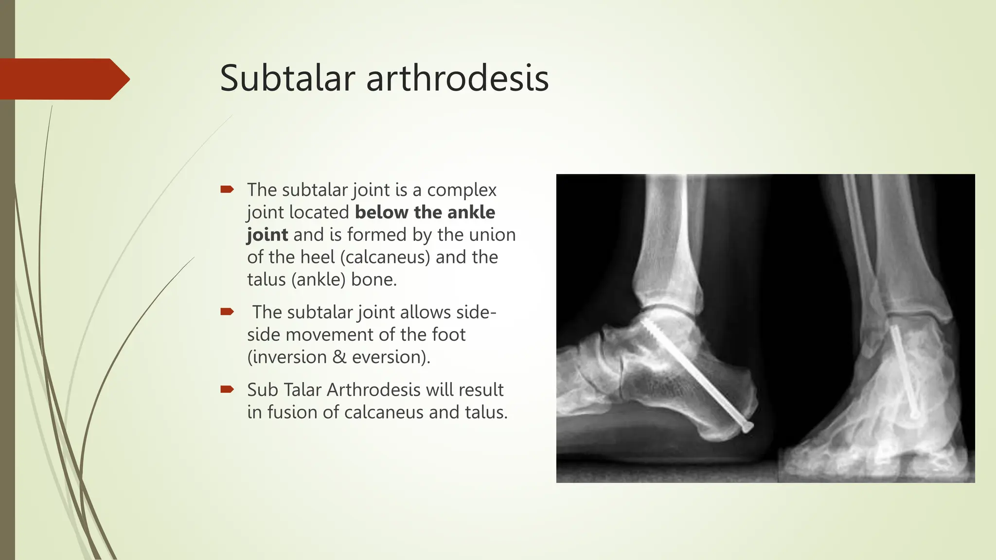 Ankle Arthrodesis.pptx