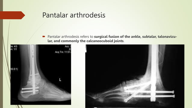 Ankle Arthrodesis.pptx