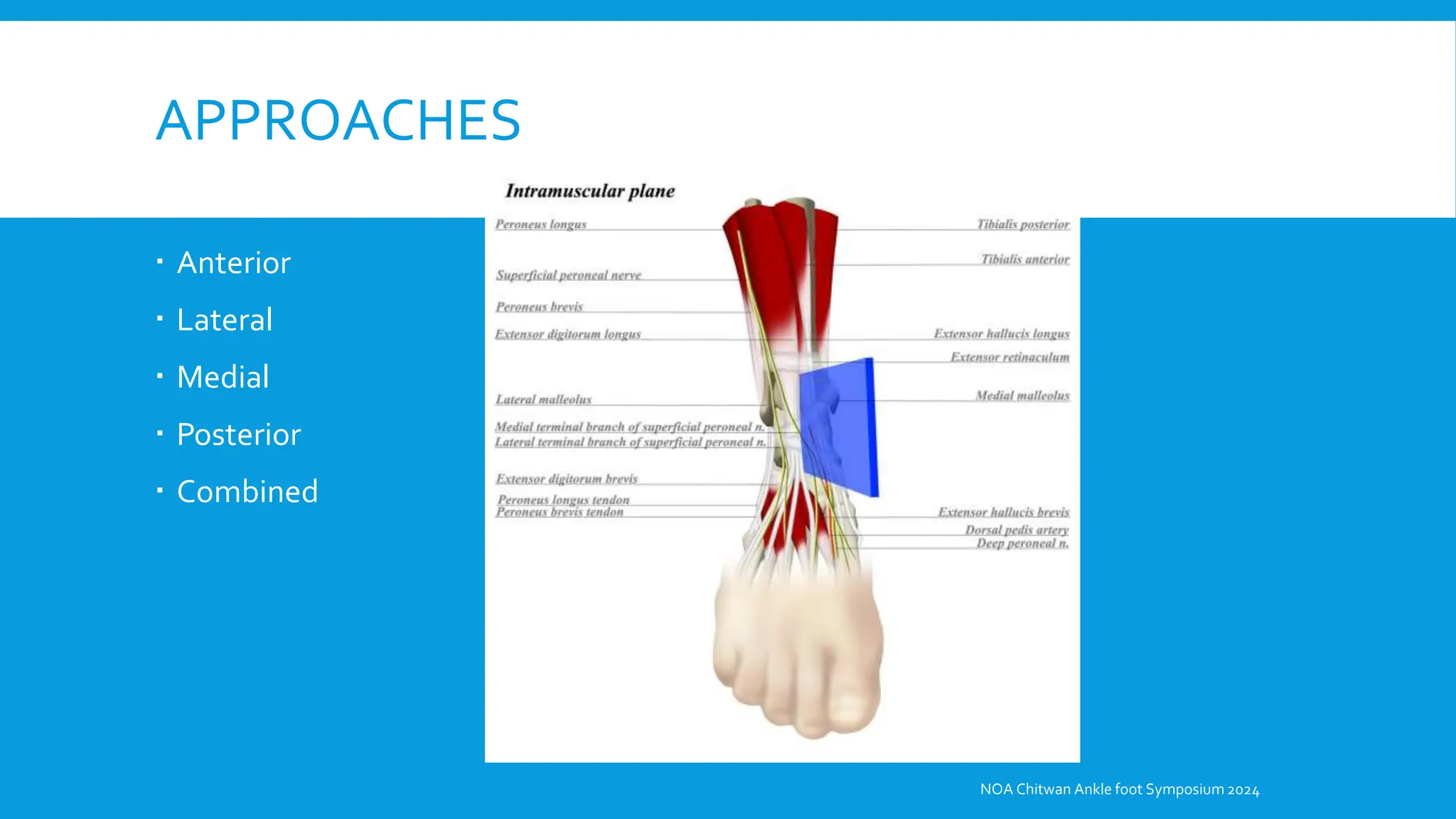 Ankle Arthrodesis, Approach and Surgical Techniques.pptx