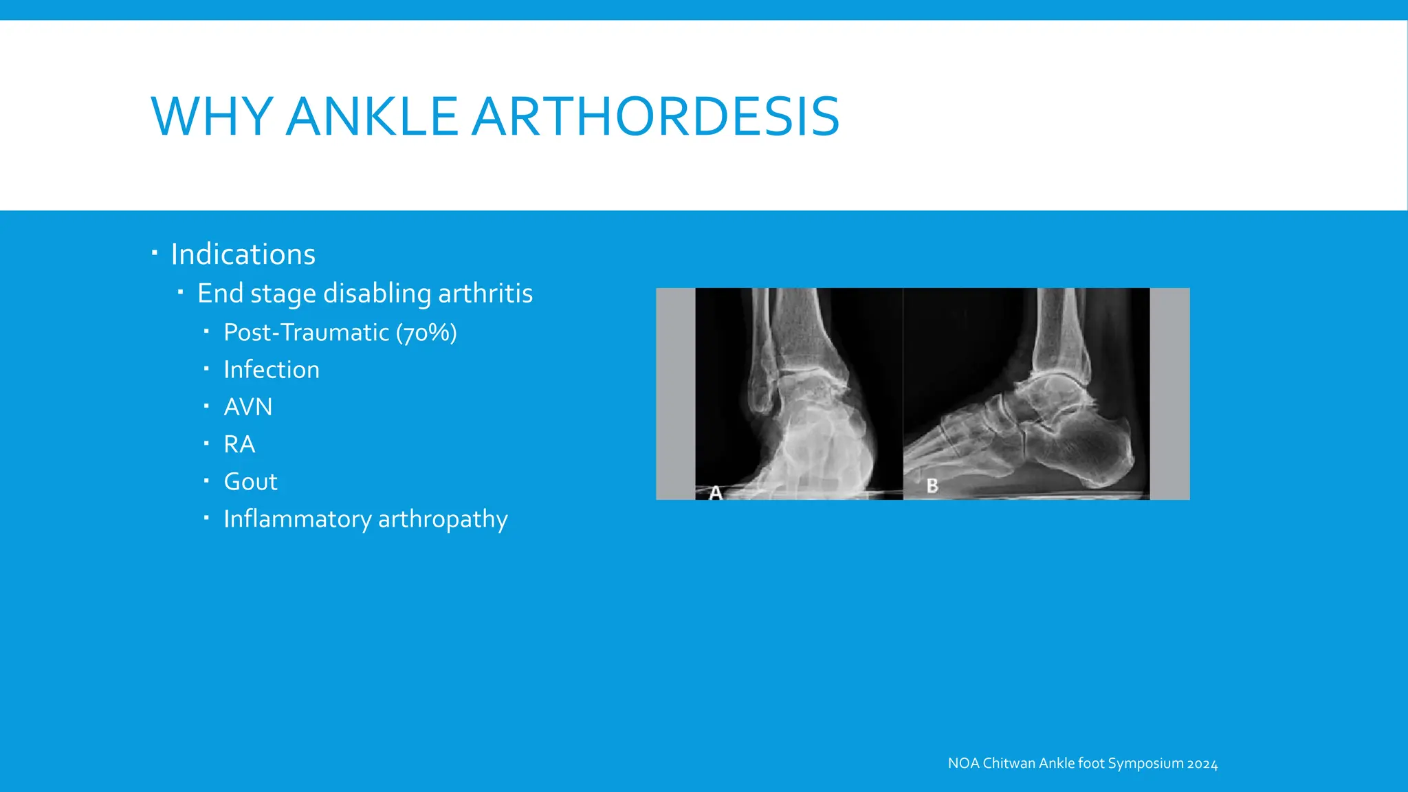 Ankle Arthrodesis, Approach and Surgical Techniques.pptx