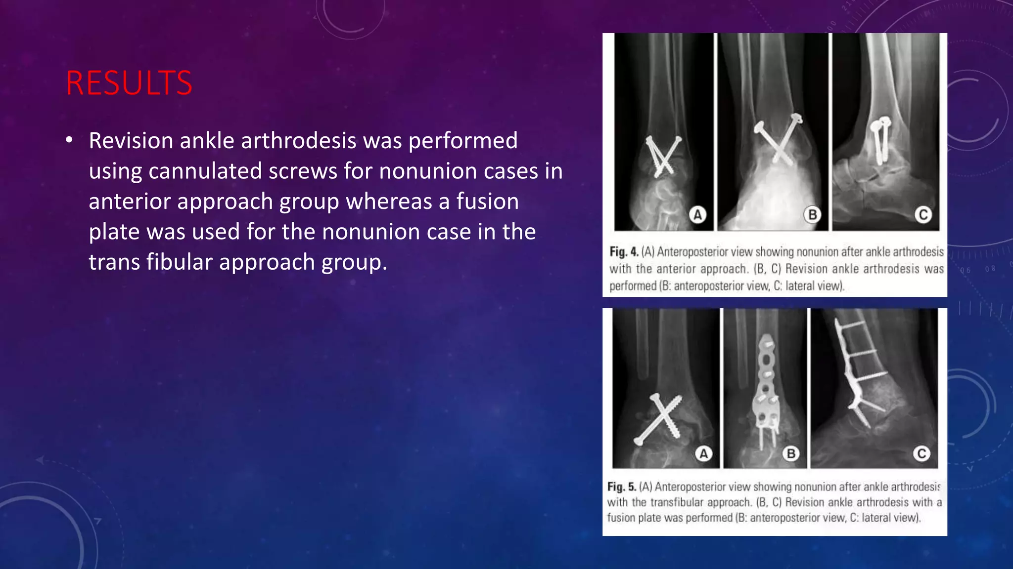 Ankle arthrodesis anterior approach and trans fibular approach which is ...