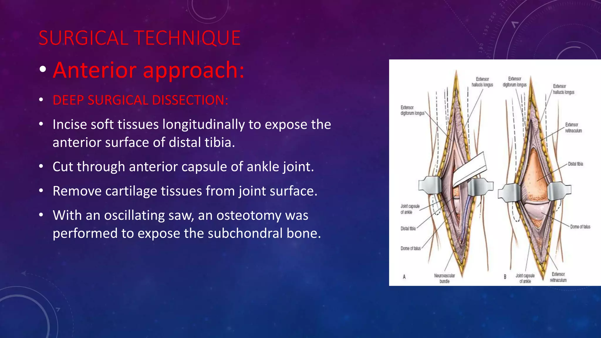 Ankle arthrodesis anterior approach and trans fibular approach which is ...
