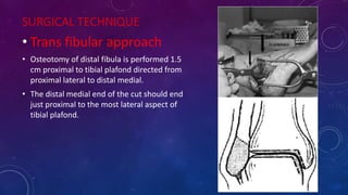 Ankle arthrodesis anterior approach and trans fibular approach which is ...