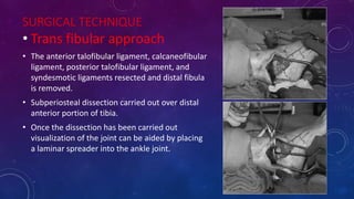 Ankle arthrodesis anterior approach and trans fibular approach which is ...