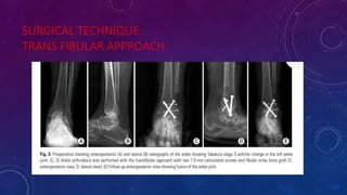 Ankle arthrodesis anterior approach and trans fibular approach which is ...