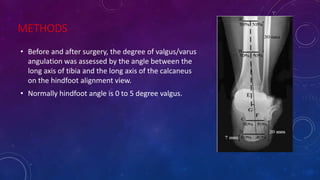 Ankle arthrodesis anterior approach and trans fibular approach which is ...