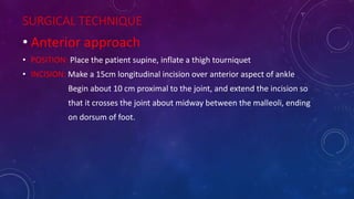 Ankle arthrodesis anterior approach and trans fibular approach which is ...