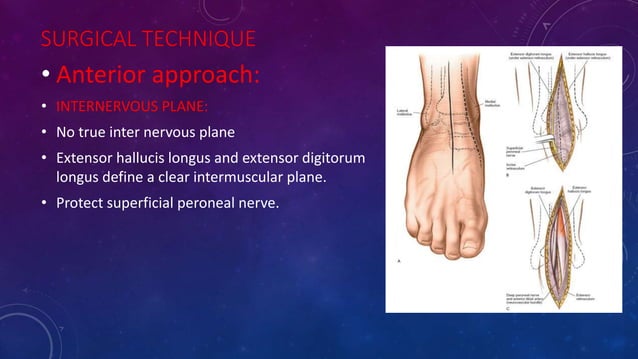 Ankle arthrodesis anterior approach and trans fibular approach which is ...
