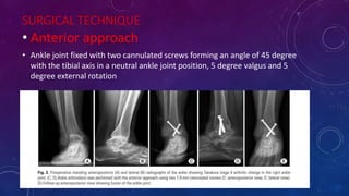 Ankle arthrodesis anterior approach and trans fibular approach which is ...