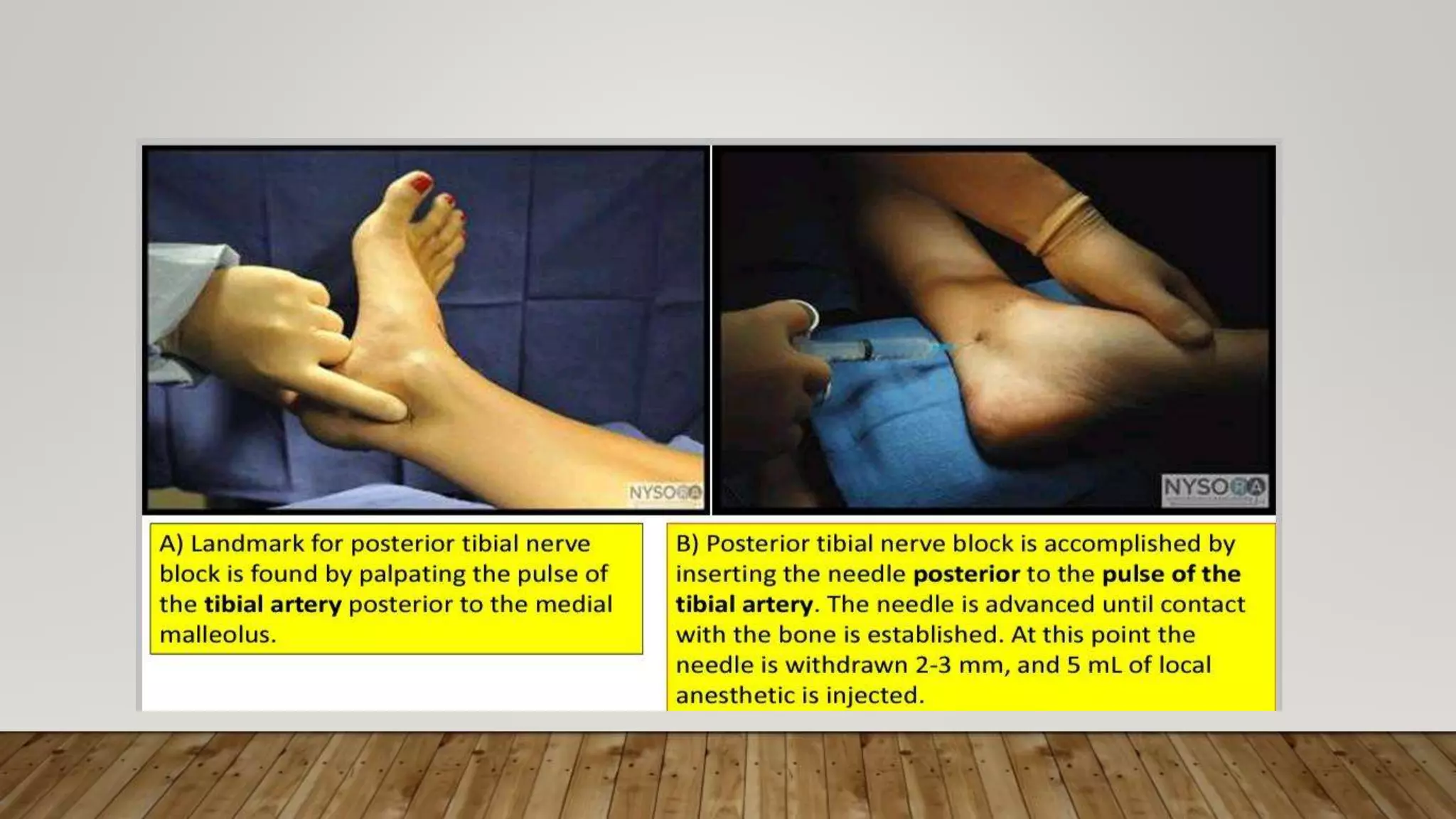 Ankle Foot Block.pptx