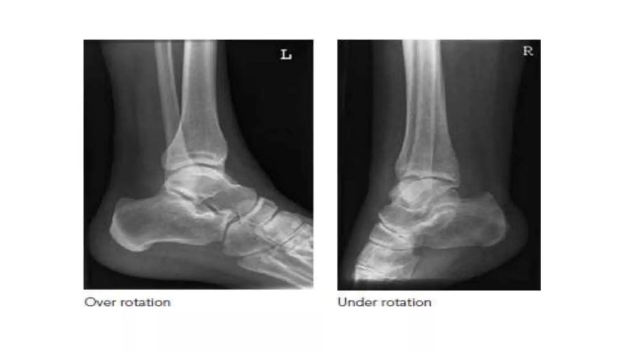 Ankle & Foot Xray & Surgical Approaches | PPTX