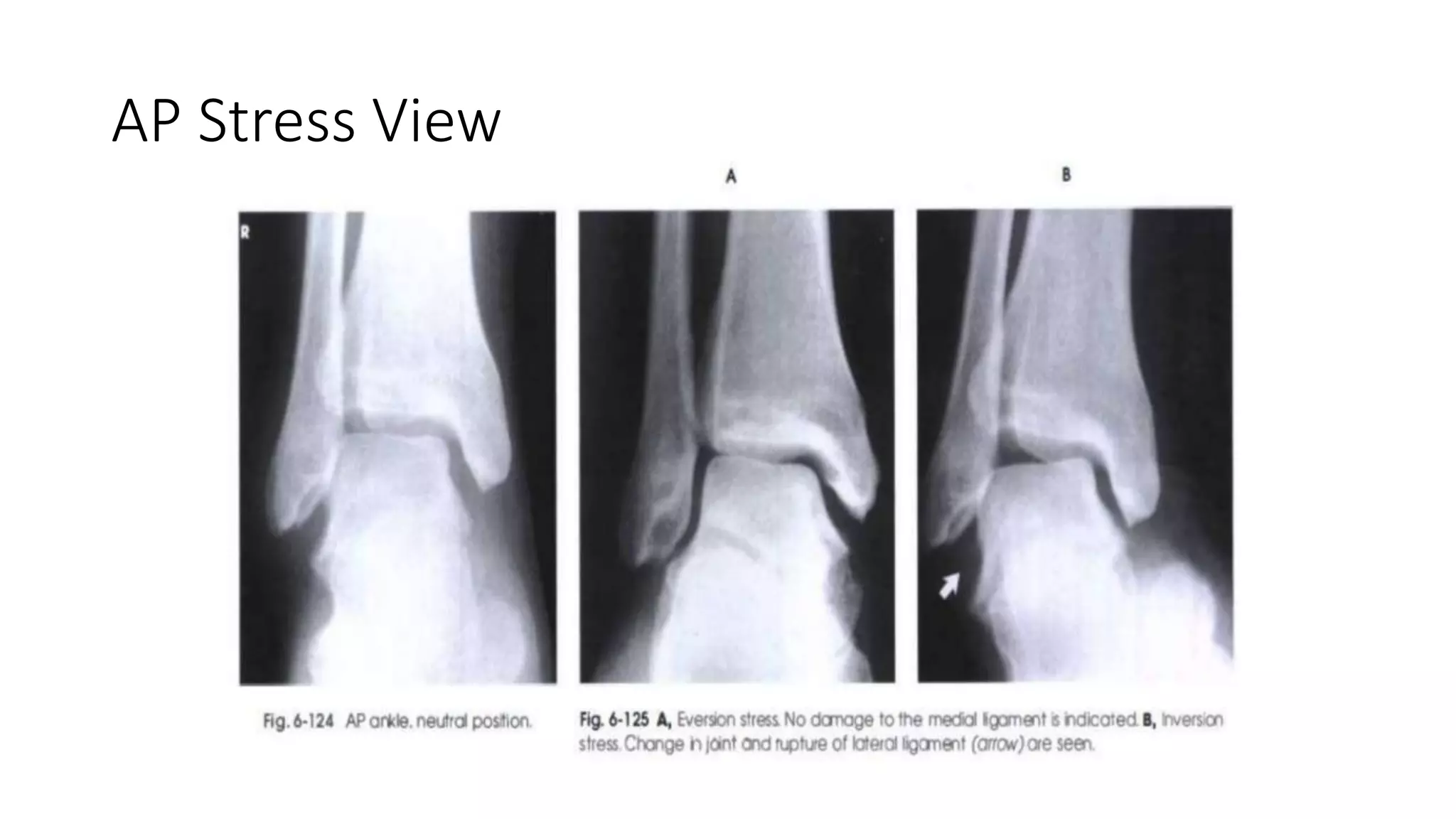 Ankle & Foot Xray & Surgical Approaches | PPTX