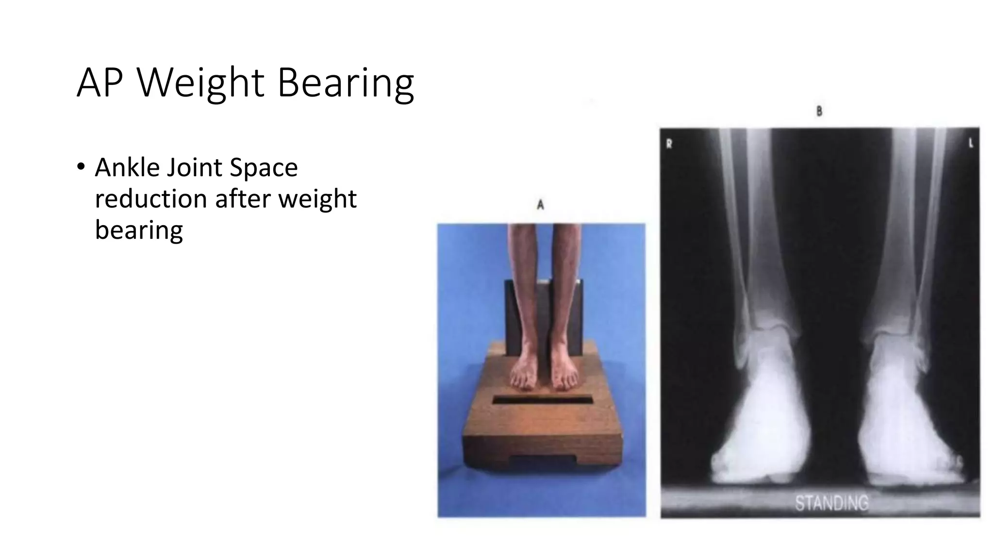 Ankle & Foot Xray & Surgical Approaches | PPTX