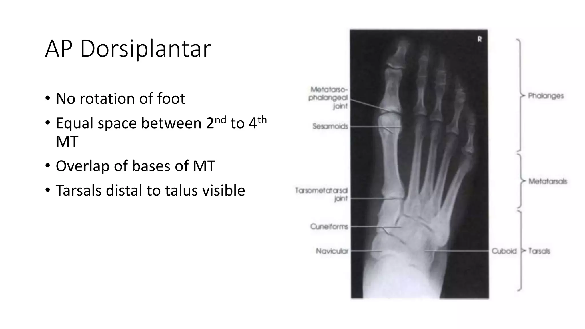 Ankle & Foot Xray & Surgical Approaches | PPTX